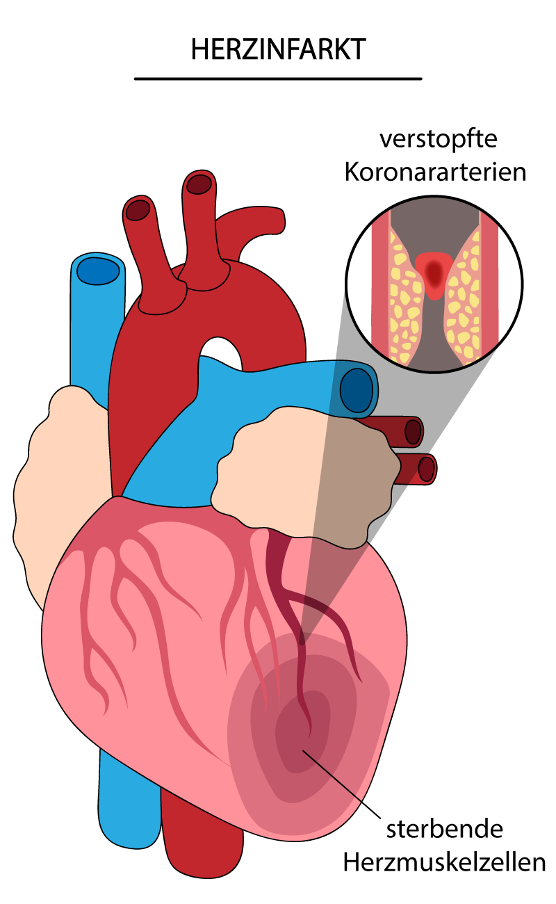 Arteriosklerose: Symptome, Behandlung & Folgen | Ratgeber